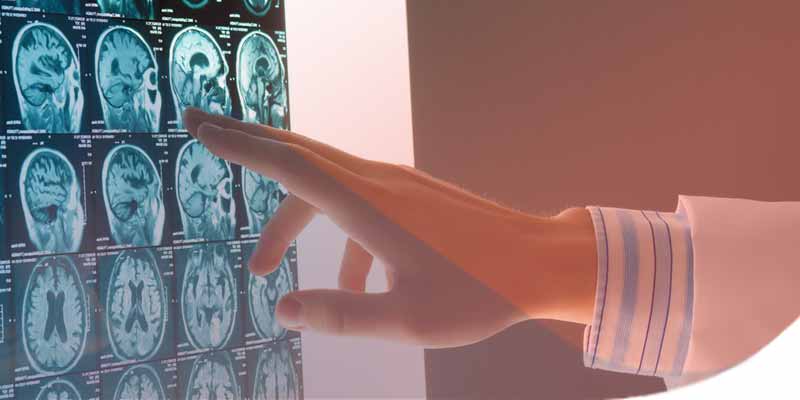 Epilepsy Advanced Online Training Course | Flexebee